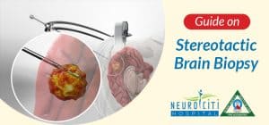 Everything you need to know about the stereotactic brain biopsy